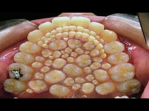 Doctors remove 232 TEETH from boy's MOUTH in a Record-Breaking operation